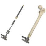 What is Osseointegration? | Osseointegration for Amputees